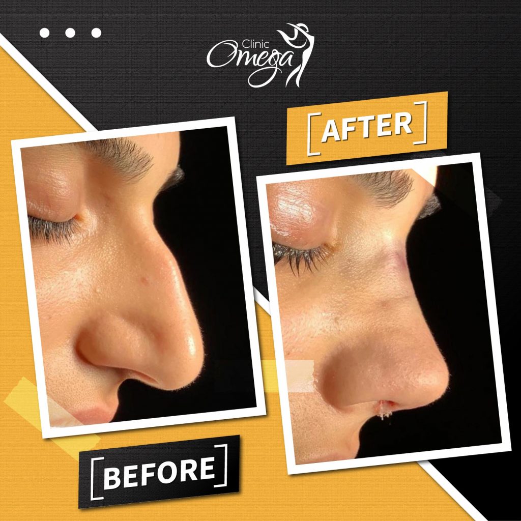Before & After - Omega