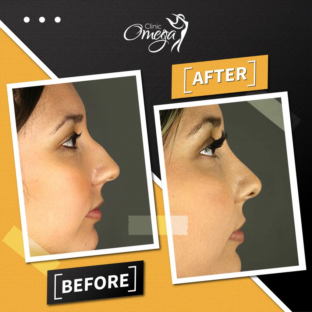 Before & After - Omega