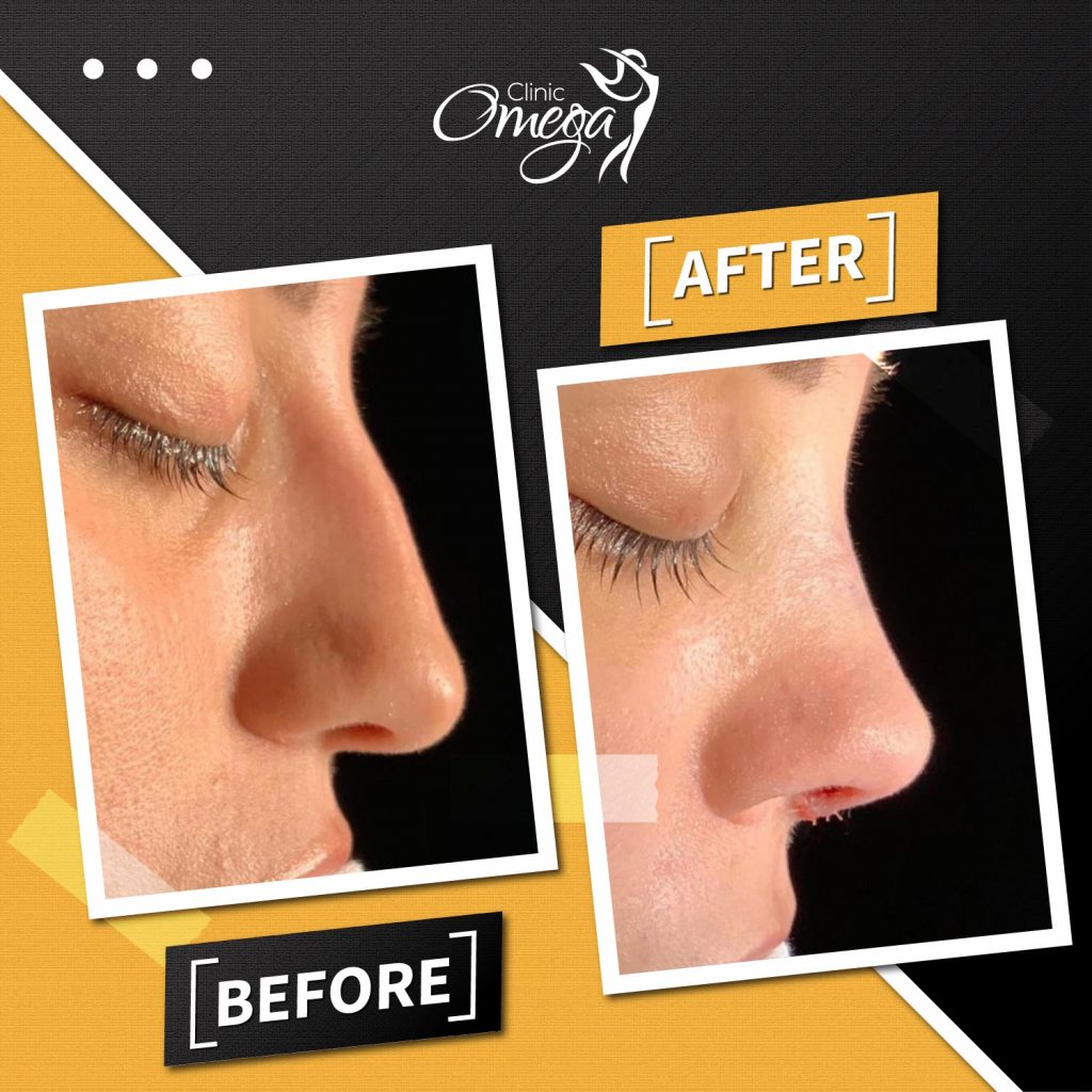 Before & After - Omega